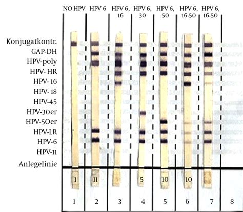 Examples Of Hpv Results Obtained Using The Linear Array Hpv Genotyping