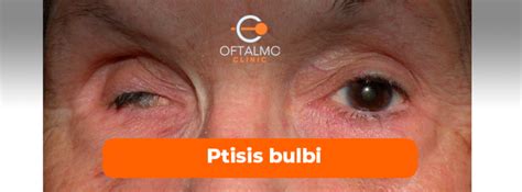 Ptisis Bulbi Oftalmoclinic