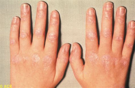 Rheum Inflammatory Myositis Flashcards Quizlet