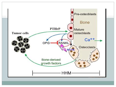 Hypercalcemia In Malignancy Pptx