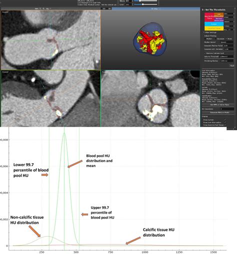 140 Fibrocalcific Volume In Aortic Valve Stenosis Using Contrast Enhanced Computed Tomography