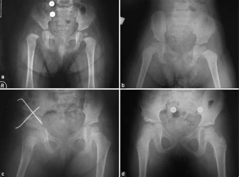 Congenital Hip Dysplasia Xray
