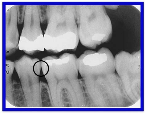 Caries Flashcards Quizlet