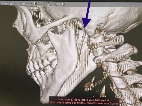 Angle Of Styloid Processes General Living With Eagle