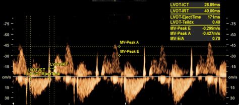 Normal Mpi And Ea Ratio Doppler Tracing Mpi Myocardial Performance Download Scientific