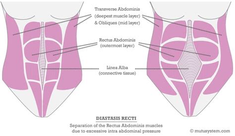 Diastasis Recti The Pooch Problem Nourishing Herbalist