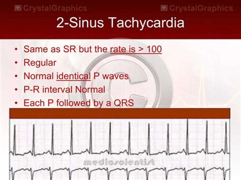 Basic Dysrhythmia Interpretation Pptx Heart And Cardiovascular Diseases Diseases And