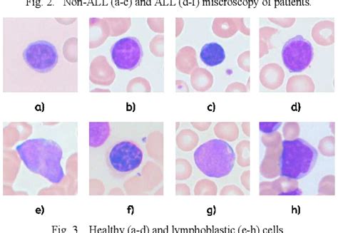 Figure 1 From A Multistage Transfer Learning Approach For Acute Lymphoblastic Leukemia