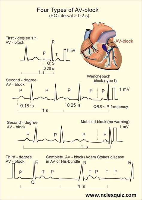 Four Types Of Av Block Nclex Quiz