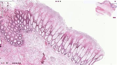 Pseudomembranous Colitis Histopathology Youtube