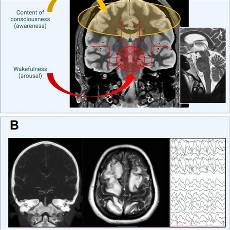 A Cortico Cortical Connectivity Involving Fronto Parietal Networks Is