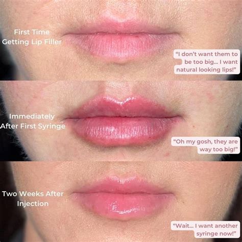 Natural Lip Filler Results Healing Process And Swelling