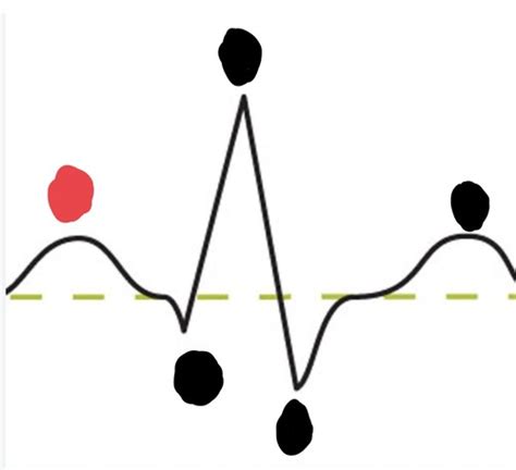Electrocardiogram Flashcards Quizlet