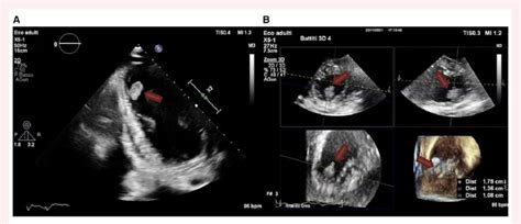 Transthoracic Two Dimensional A And Three Dimensional B