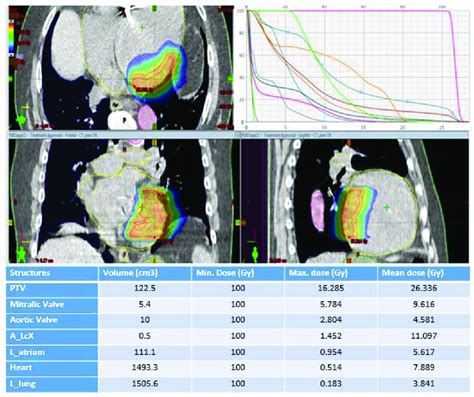A Dose Distribution Representation Of Radiotherapy Planning And Dose