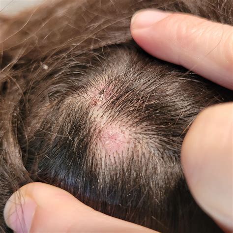 Itchy Scalp Rashlesions Rdermatology