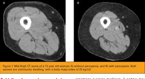 Pdf Sarcopenia Exercise As A Treatment Strategy Semantic Scholar