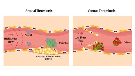 Thrombosis Causes Symptoms Diagnosis And Treatment