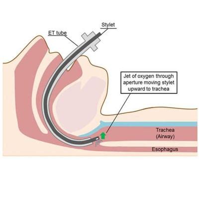 Endotracheal Tube Placement