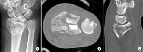 Comminuted Distal Radius Fracture Was Classified As Arbeitsgemeinschaft