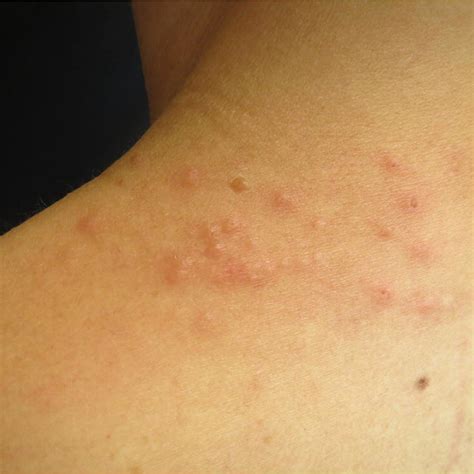 Multiple Pinpoint Flesh Colored Papules On Sun Exposed Skin Of A