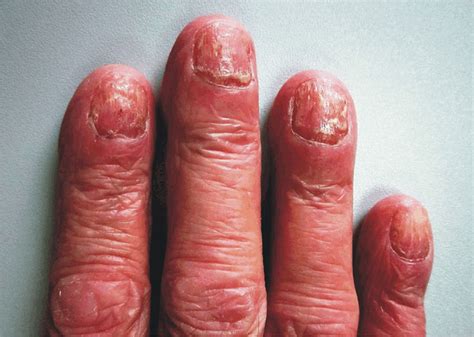 Psoriasis Nails Oil Spot