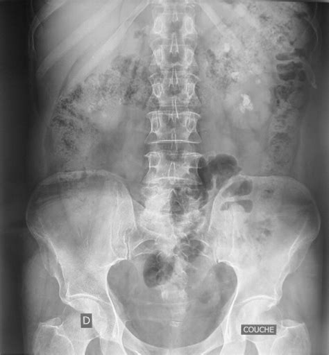 Figure 1 From Giant Pyonephrosis Related To Nephrolithiasis In Diabetes Woman A Case Report