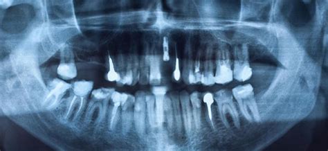 Oral Cancer Screening Early Detection Starts Here Bondi Dental