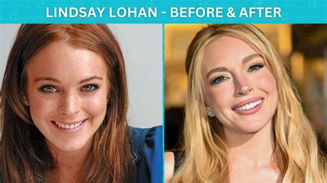 Famous Celebrity Veneers Before And After Hollywood Smile