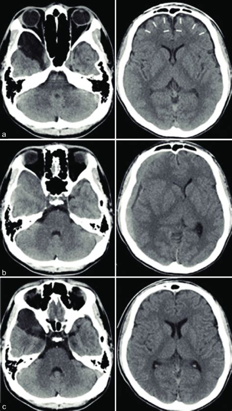 Brain Computed Tomography Ct Of The Patient Ct Obtained 2 Days After Download Scientific