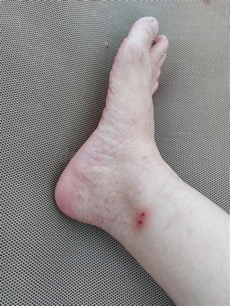 Skin Bruises On Caucasian Female Buttocks Side View Close Up Shot No