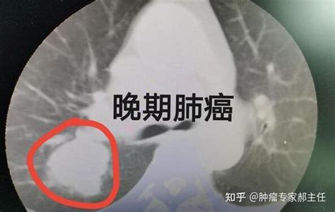 肺癌晚期如何治疗效果好 知乎