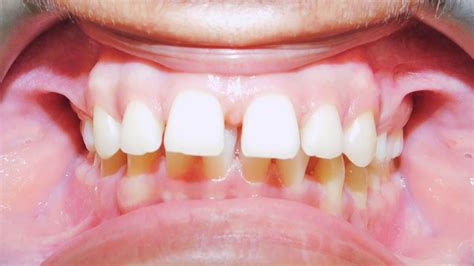 Class I Malocclusion Severe Deep Bite Excessive Overjet Proclined Upper Incisors Case Gallery