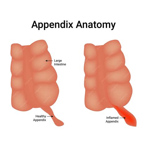 Premium Vector Appendix Anatomy Large Intestine Healthy Appendix