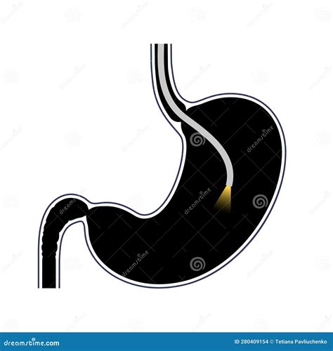 Gastroscopy Endoscopy Procedure Stock Vector Illustration Of Woman Gastro 280409154