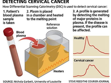 University Of Louisville Study New Blood Test Can ID Cervical Cancer