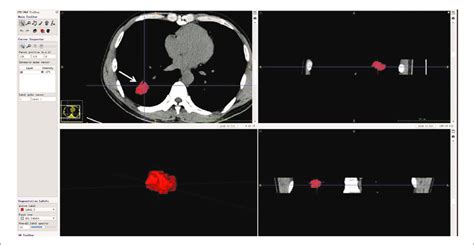 Ct Scan Of The Patient Woman 77 Years Old Showing A Solid Nodule In Download Scientific