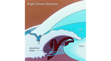 Unveiling Drug Induced Angle Closure Glaucoma Key Findings From A