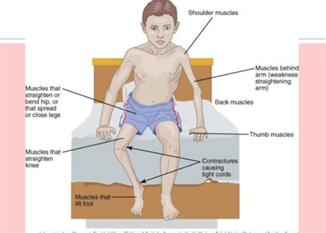 Poliomyelitis And Post Polio Syndrome Flashcards Quizlet