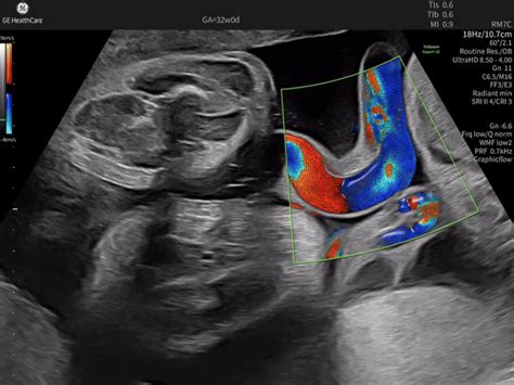 The New Voluson Expert Series Ge Healthcare