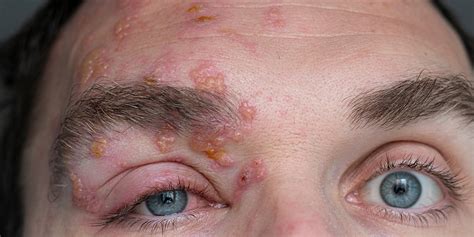 Херпес зостер Снимки Лечение Дерматолог в София