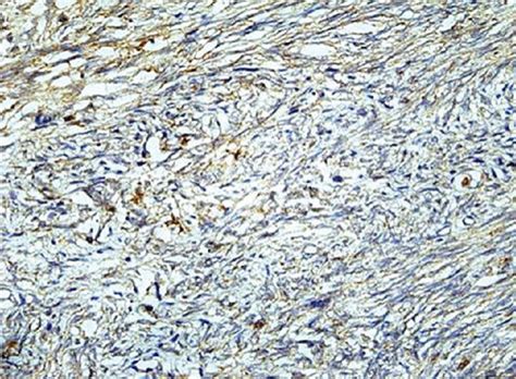 The Protein Expression Of Tgf β2 And Tgf β3 In Human Ovarian Cancer And Download Scientific