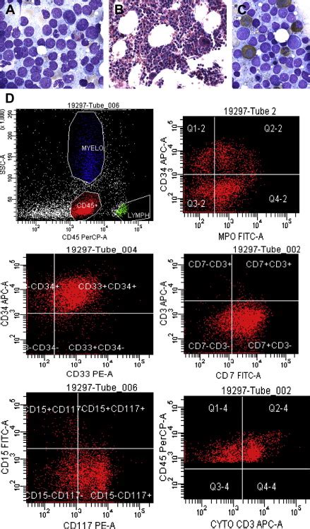 Oddballs Acute Leukemias Of Mixed Phenotype And Ambiguous Origin Oncohema Key