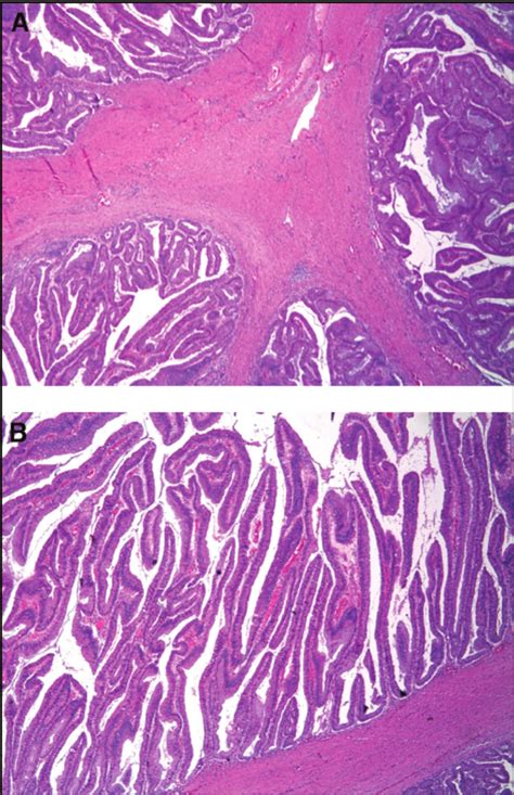 Histologic Sections Of The A Tubulovillous Adenoma And The B