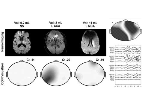 Point Of Care Brain Monitoring Algorithm For Detecting Stroke In
