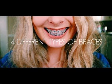 DIFFERENT TYPES OF BRACES YOU CAN GET Update And Exciting News Zoe Powers