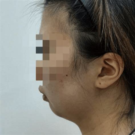 파워v얼굴지방흡입 이중턱 근육묶기 실리프팅 후기 닥터정 리반의원 파워v얼굴지방흡입 이중턱 근육묶기 실리프팅 후기 닥터정 리반의원