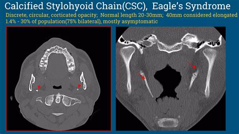 Soft Tissue Calcification In The Neck Pptx