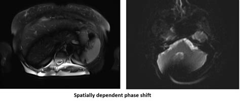 Spatially Dependent Phase Shift Artifact
