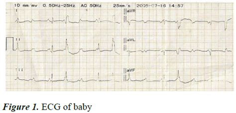 Case Report Of Complex Congenital Heart Block In A Term Female Nigerian Neonate